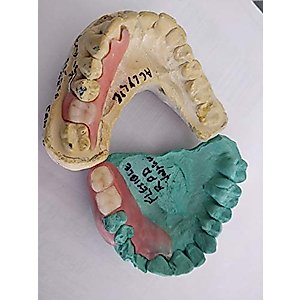 "Nesbit bridge" , Flipper Uppler and Lower Set of Affordability Flexible Valplast Customized Partial Denture (Pink, Valplast)