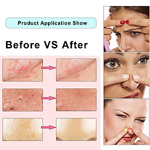 7PCS Blackhead Remover, Blackheads Extraction Removal Tool, Blemish Acne Pimple Extractor, Stainless Steel Removing Kit, Nose Face Clean Tools by OMDEAL