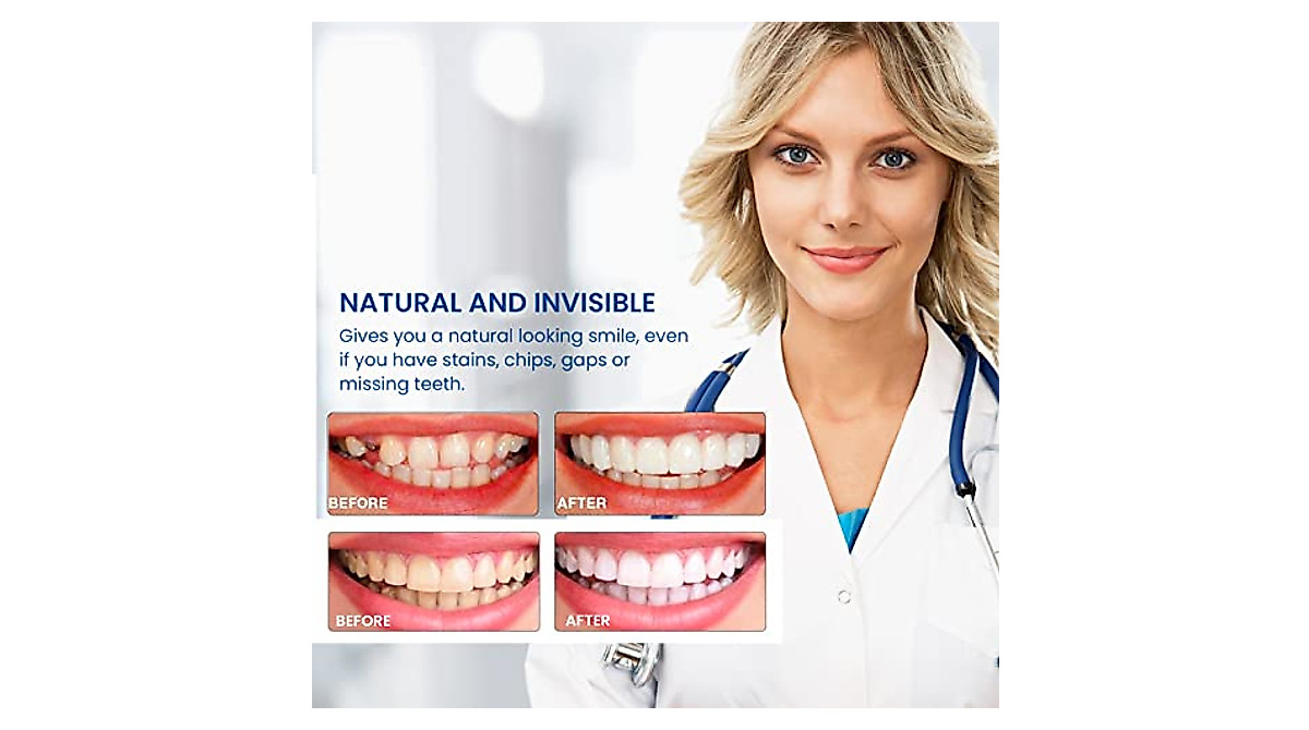 Customizable Snap-on Veneers Teeth for Confident Smiles