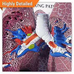 Lung Model Set | Human Body Anatomy Replica of Lung Cancer for Doctors Office Educational Tool | GPI Anatomicals