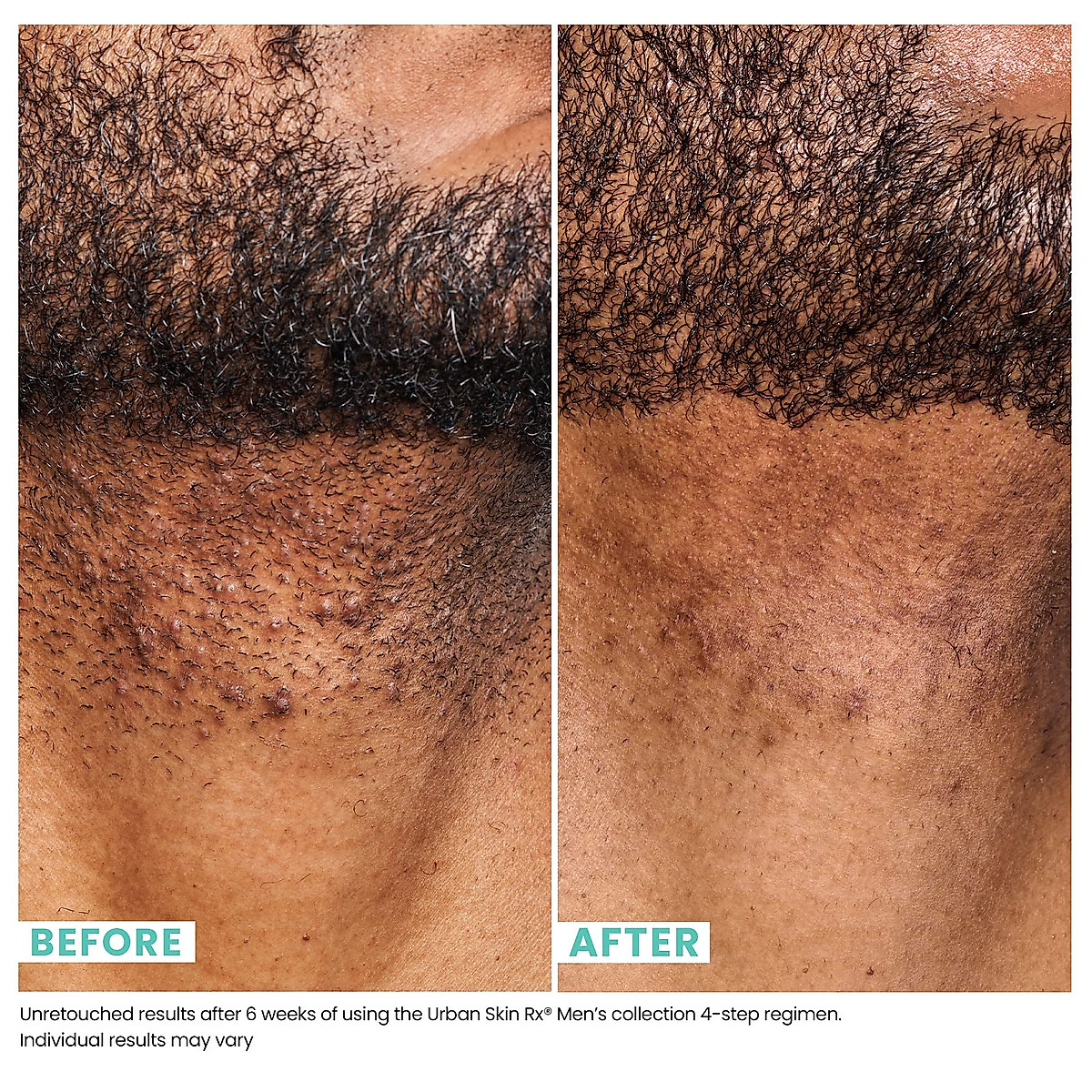 Daily Mens Exfoliating Face Wash + Scrub | Urban Skin Rx® | Powerful 2-in-1 Cleanser and Scrub | Cleans Pores of Dirt and Oil. Formulated with Salicylic Acid, Jojoba Beads and Niacinamide | 5.1 fl oz