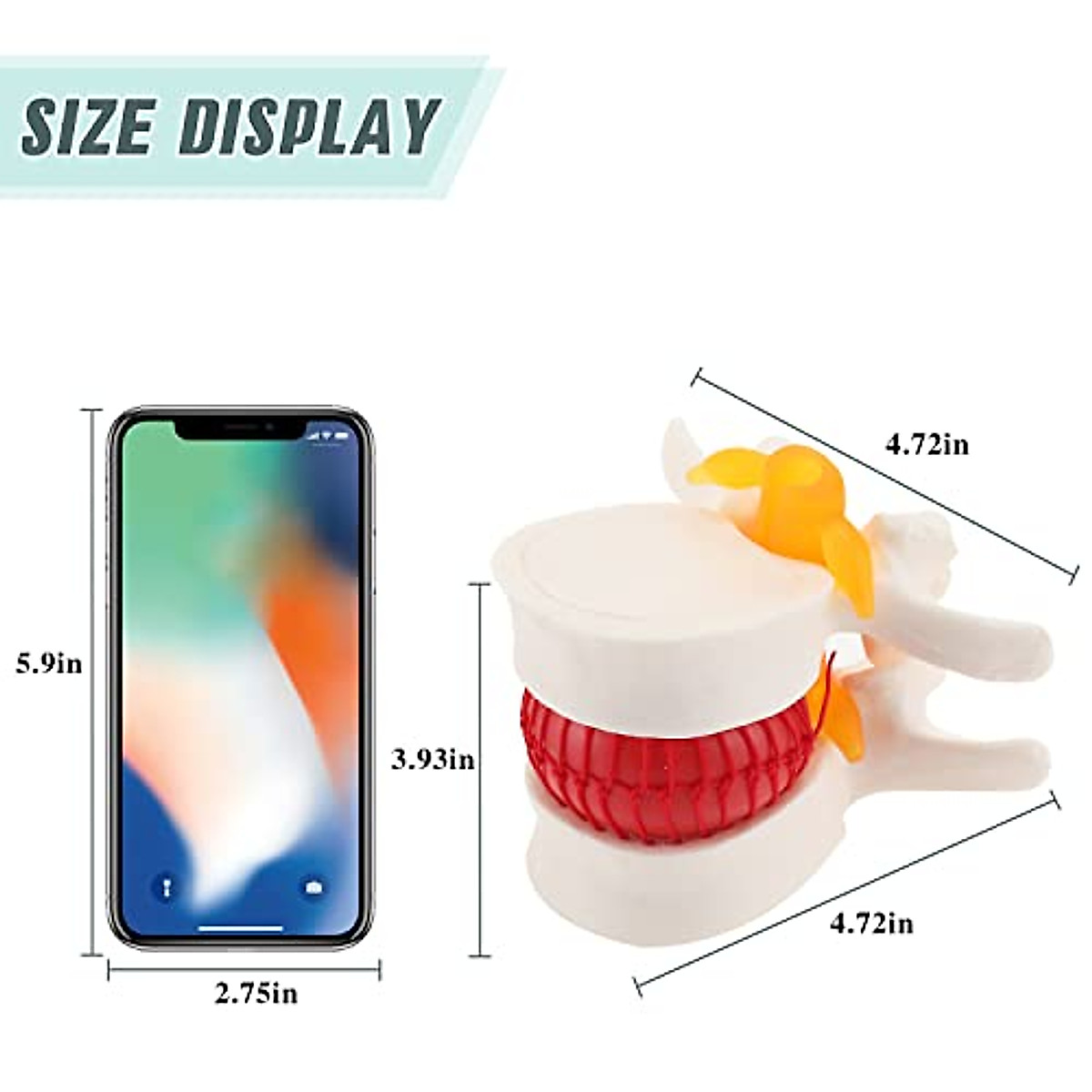 RONTEN Lumbar Disc Herniated Model, Human Anatomical Lumbar Spine Model for Medical Teaching & Learning