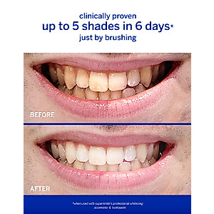 Supersmile Professional Teeth Whitening System , 1 Count (Pack of 1)