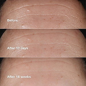 Clinique Smart Clinical Repair Wrinkle Correcting Face Serum With Hyaluronic Acid, Peptides + Advanced Retinoid Serum | Anti-Aging + Hydrating, 3.4 Fl Oz