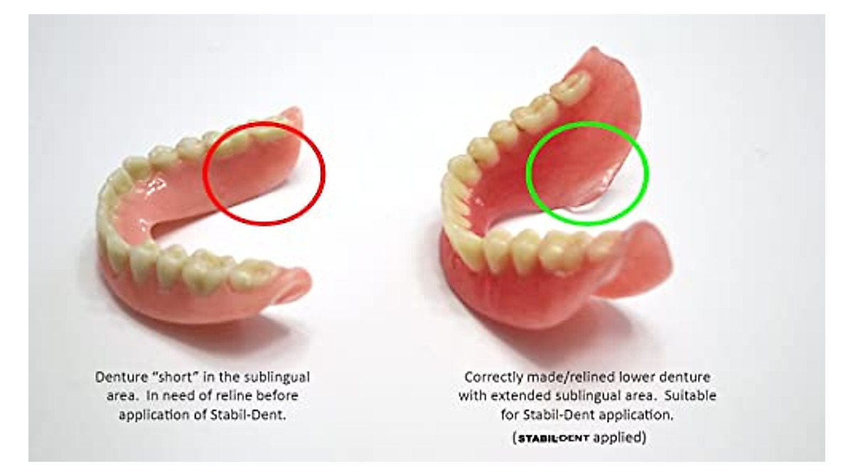 Stabilize Your Dentures with Stabil-Dent