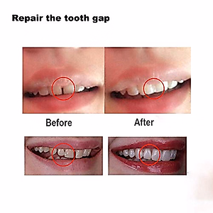 Tooth Filling Thermal Beads Do it Yourself Moldable False Teeth for Temporary Tooth Repair the Missing and Broken Tooth Replacement Kit(2 pack)