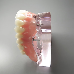 Dental Model Overdenture Upper Teeth 4 Implants Demo for Teaching and Studying