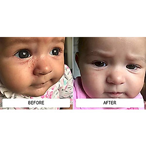 Happy Cappy Dr. Eddie’s Medicated Shampoo for Children, Treats Dandruff & Seborrheic Dermatitis, No Fragrance, Stops Flakes and Redness on Sensitive Scalps and Skin, Cradle Cap Brush Not Needed, 8 oz