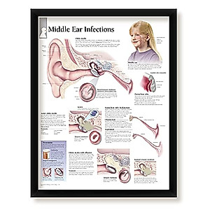 Set of 4 Framed Medical Posters Ear, Nose and Throat, Understanding Sinusitis, Understanding Rhinitis, and Middle Ear Infections 22"x28" Wall Diagrams