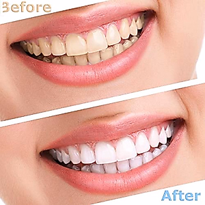 CHNLML,2 PCS Dentures Teeth - Temporary Teeth Perfect Fake Teeth - Veneers Dentures for Men and Women