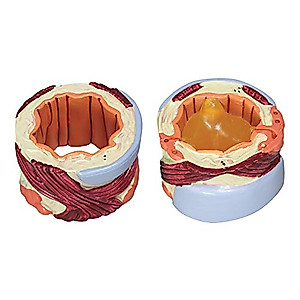 GPI Anatomicals - Anatomy Model of Human Respiratory System with Chronic Obstructive Pulmonary Disease (COPD), Bronchus and Alveoli Models for Anatomy and Physiology Education, Medical Study Supplies