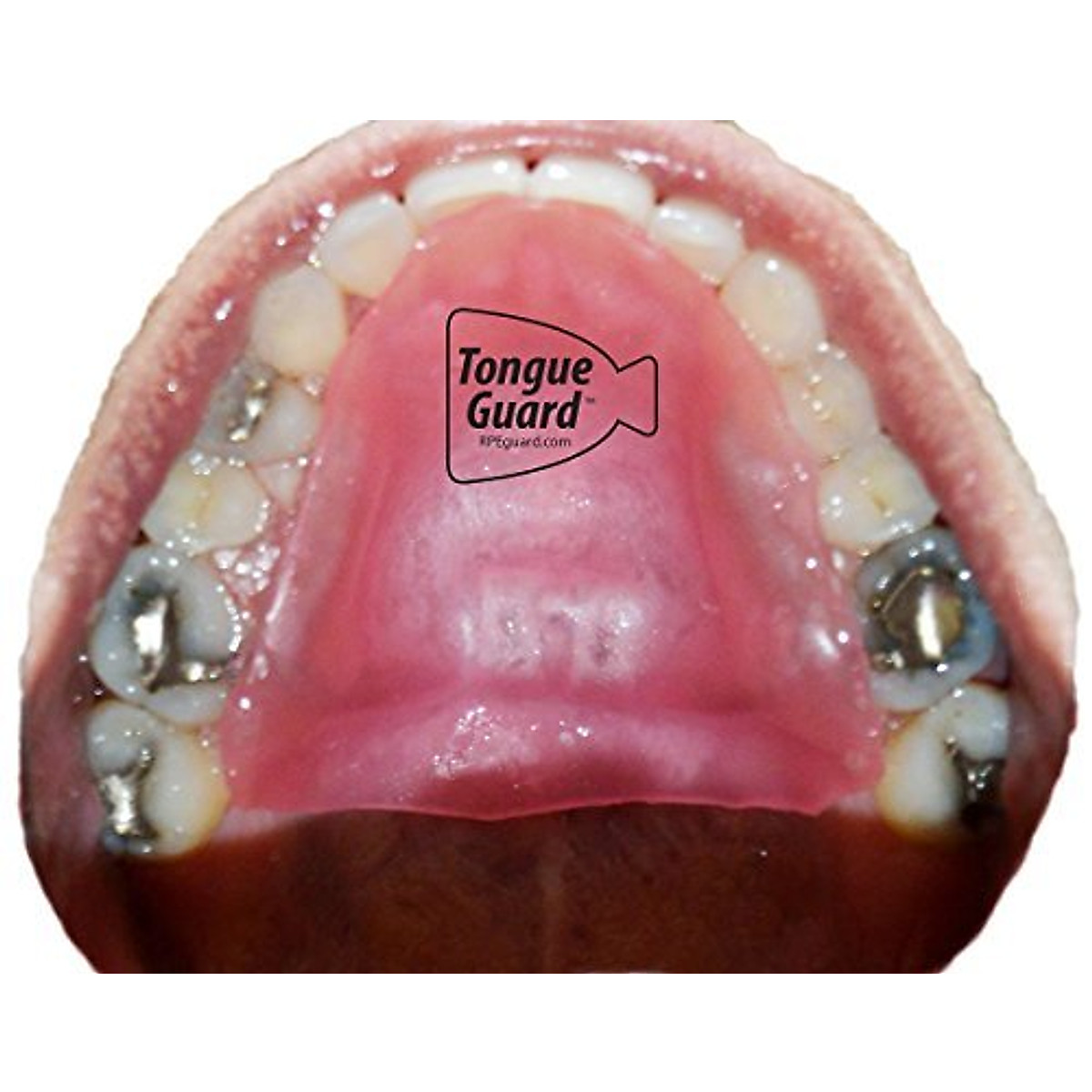 RPE Tongue Guard: Prevents and Helps Heal Tongue Sores Caused by Dental Expanders