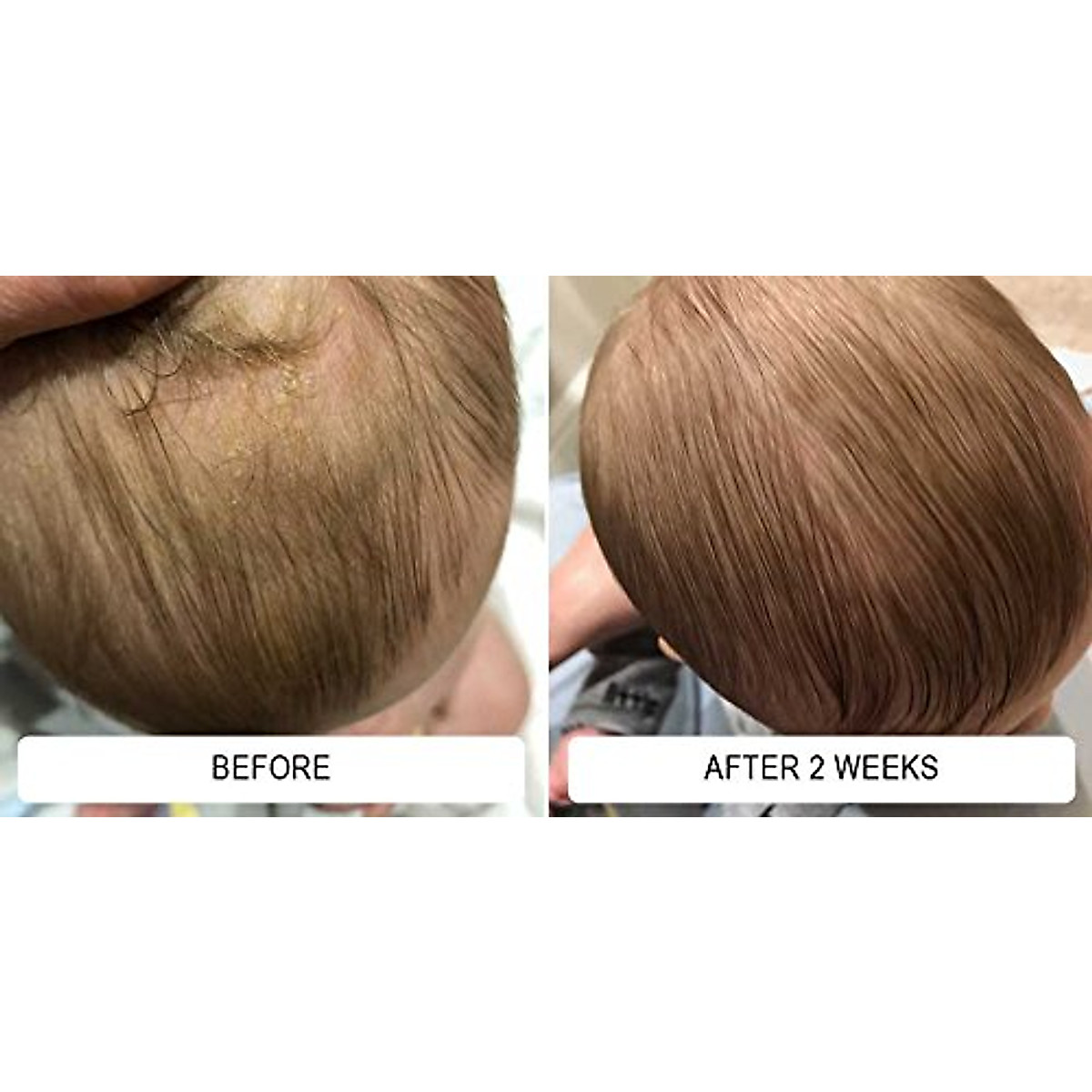 Happy Cappy Shampoo Bundle | Manage Cradle Cap, Seborrheic Dermatitis, Dandruff, and Dry, Itchy, Sensitive Eczema Prone Skin for All Ages…