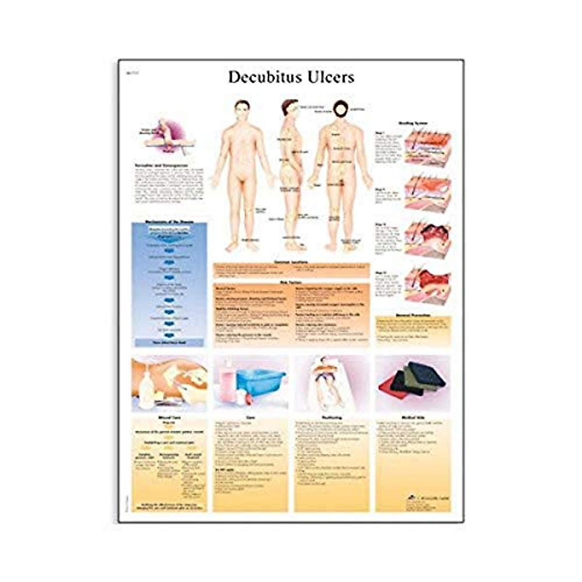 3B Scientific VR1717L Glossy UV Resistant Laminated Paper Decubitus Ulcers Anatomical Chart, Poster Size 20" Width x 26" Height