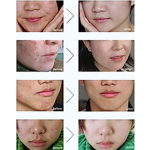 BIOAQUA Acne Scar Natural Blemish Gel Acne Pimple Acne Spot Removal Cream, Oil Control Shrink Pores Face Care Cream