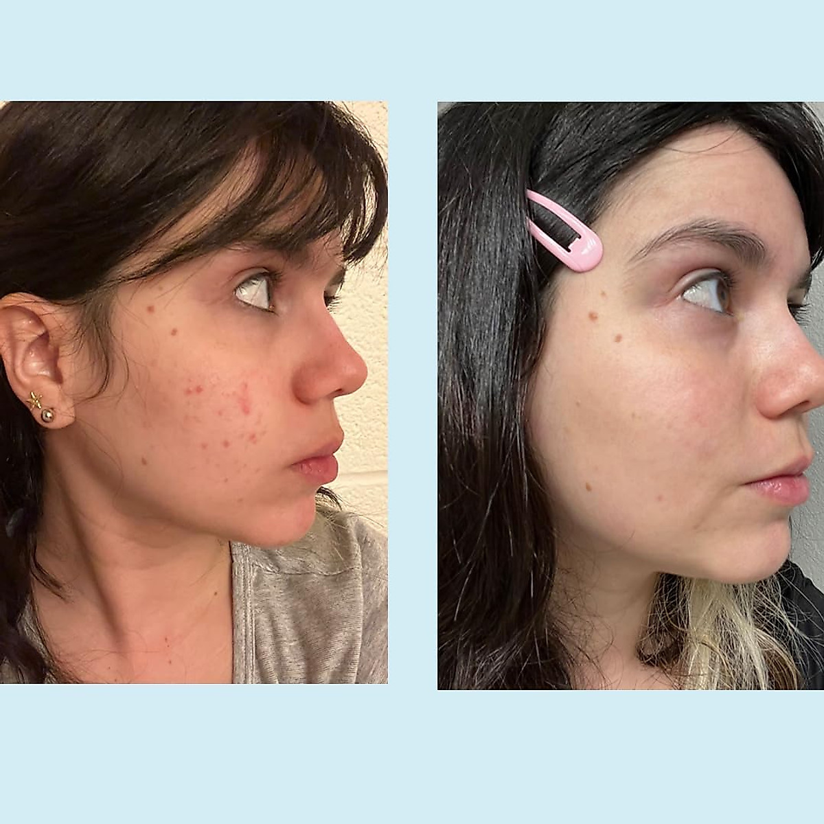 Glycolic Acid 50% Gel Peel - Enhanced with Retinol & Green Tea Extract (Professional Skin Peel)1 ounce