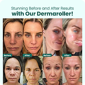 Gin Amber Dermaroller (0.25mm) - 192 Real Individual Needles, Microdermabrasion Device for Skin Care, Serum Absorption with Microneedling, Safe and Painless Revitalizer Tool, Hygienic Case