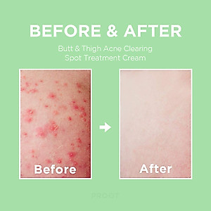 Butt Acne Treatment Cream in Tube Type | Travel Friendly | Clears Acne, Ingrown Hairs, Zits, Razor Bumps, Blackheads and Dark Spots for the Butt, Thigh and Other Sensitive Area | Prevents Future Breakouts