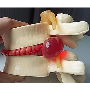 New 2pcs Anatomical Human Lumbar Vertebrae Degenerative Lumbar disc herniation demonstration model Human spine Sold by East Dental