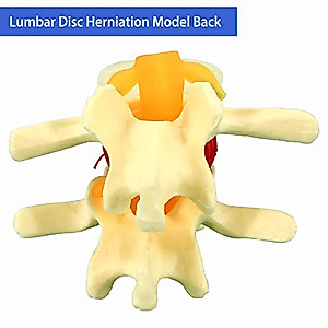 Veipho Human Anatomical Lumbar Disc Herniation Model, 1.5 Times Life Size Lumbar Disc Herniation Model, Human Lumbar Disc Herniation Model for Teaching, Learning, Demonstrating