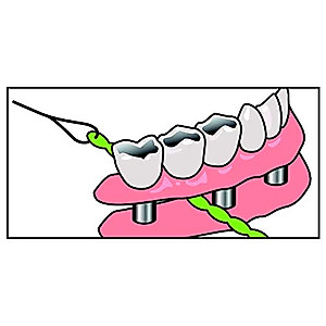 IDontix Brace X-Floss, Green