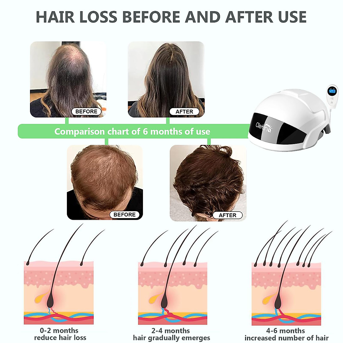 CLETINA Laser Hair Growth System - Hair Loss Treatments For Hair Regrowth - Ideal for Thinning Hair Treatment by Using Red Light and Laser Therapy