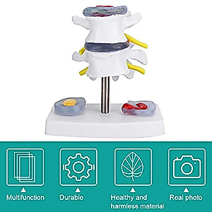 Wene Human Spine Model, Professional Vivid Lumbar Model Clearly Study with 2 Diseased Intervertebral Discs for School