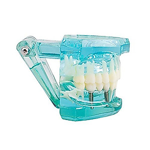vinmax Dental Teeth Model,Transparent Dental Implant Disease Teeth Model Dentist Standard Pathological Removable Tooth Teaching Tools for Student (Pathological Teeth Model)
