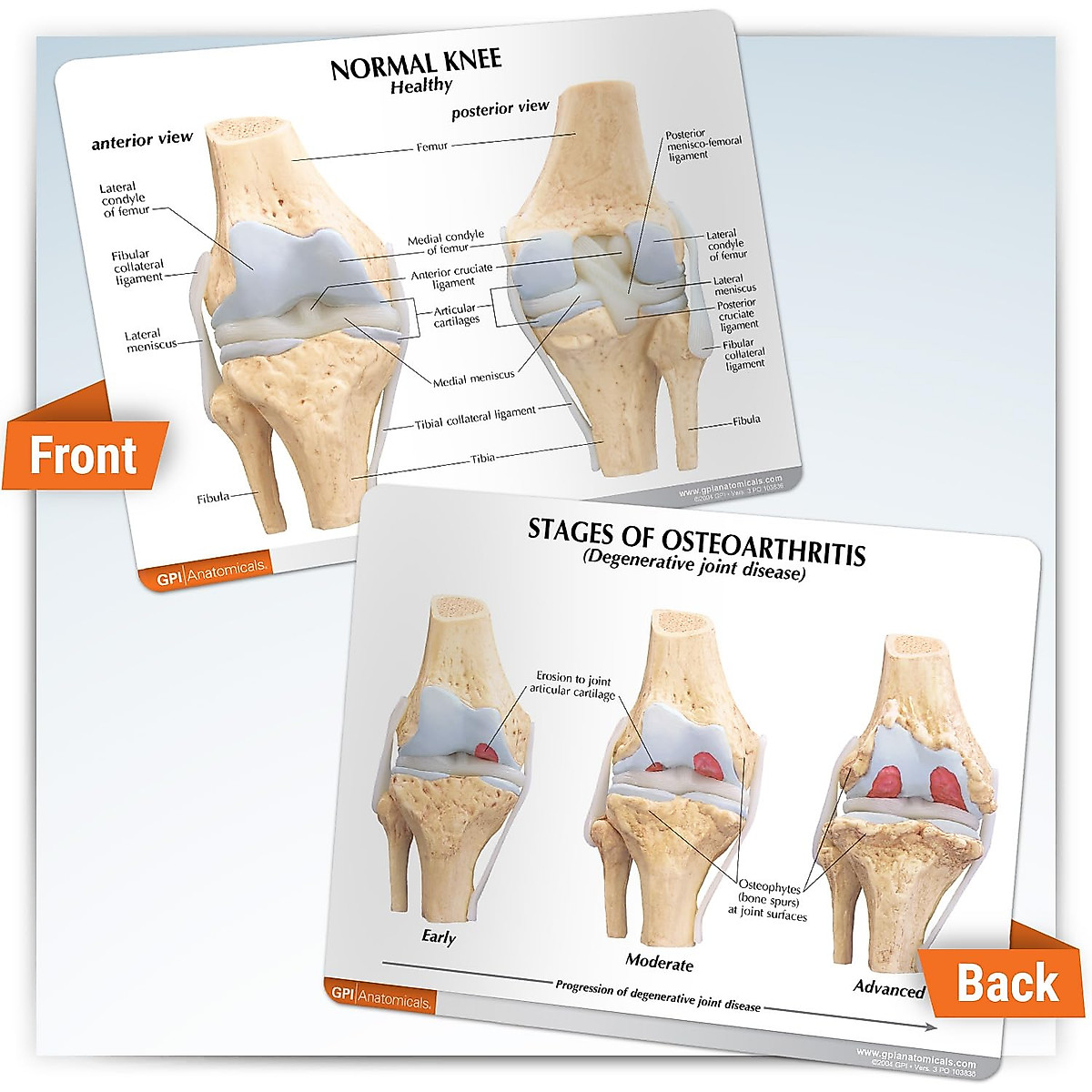 GPI Anatomicals Knee Joint Model Set | Human Body Anatomy Replica Set of 4-Stage Osteoarthritis Knee Joint for Doctors Office Educational Tool