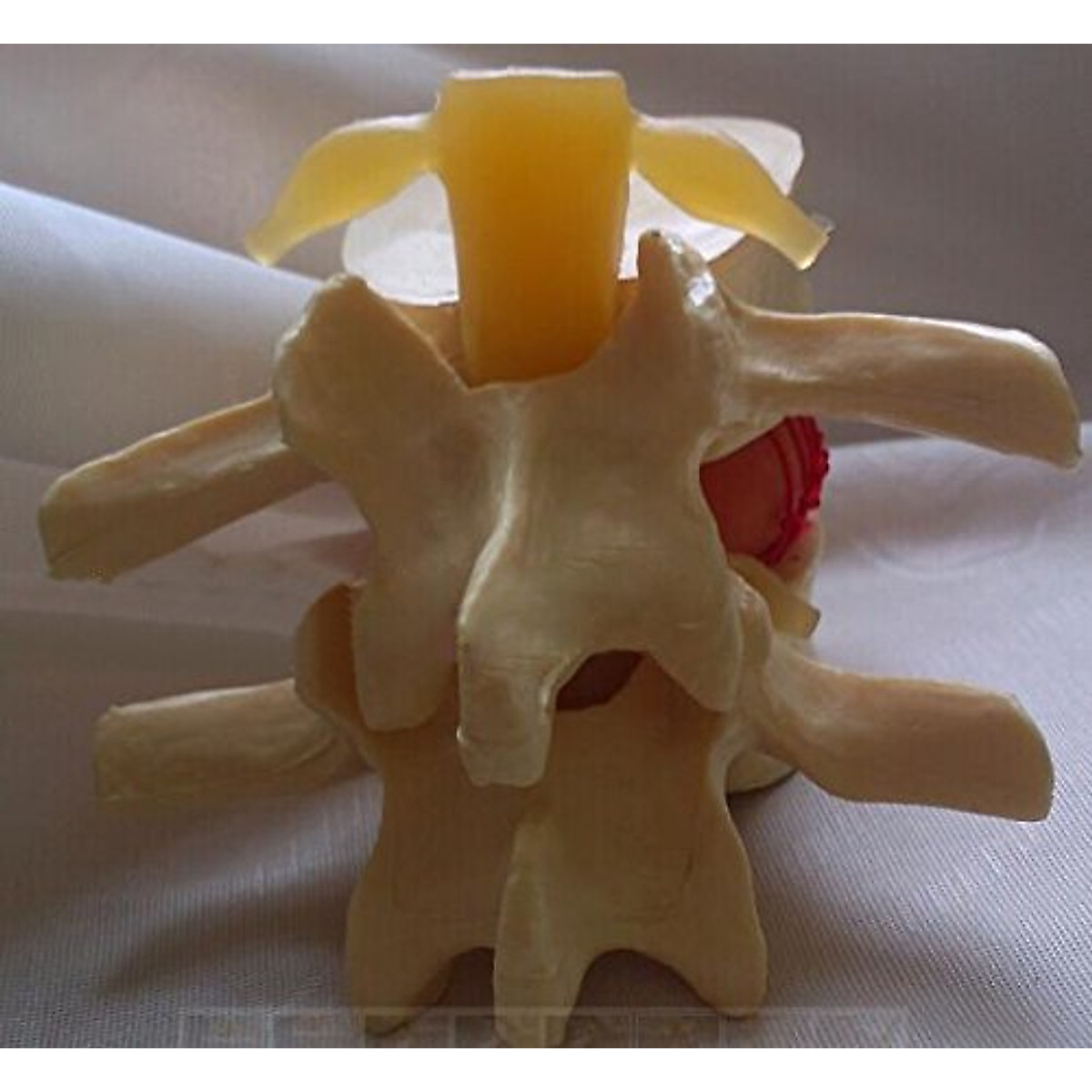 New 2pcs Anatomical Human Lumbar Vertebrae Degenerative Lumbar disc herniation demonstration model Human spine Sold by East Dental