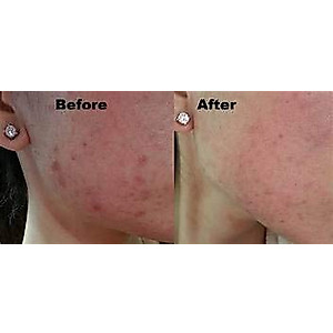 Estrogen Blocker for Men & Hormone Balance for Women- E-Block- Natural PCT Aromatase Inhibitor Anti Estrogen Acne Support Formula Post Cycle Therapy Supplement Plus DIM, Calcium-d-glucarate, Chrysin