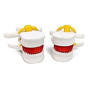 Human Herniated Disc Model, Anatomical Herniated Lumbar Vertebrae Disc Prolapse Model for Medical Teaching Learning, Education Display Tooling, Kids Learning Education Display Tool 2 Pack