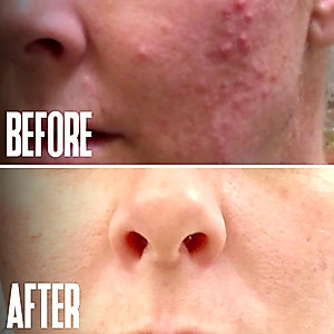 Glycolic Acid Peel 40% Professional Chemical Peel for Face for Acne Scars, Collagen Boost, Wrinkles, Fine Lines - Alpha Hydroxy Acid Liquid Exfoliant for Face Peel Mask for Men & Women