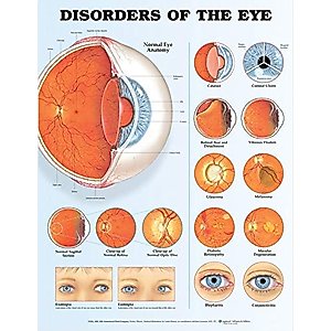 Disorders of The Eye Anatomical Chart