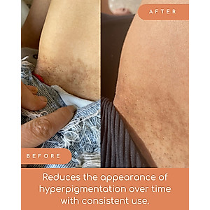 Forgotten Skincare The Down Low Inner Thigh Serum for Razor Burn, Ingrown Hairs & Dark Spots On Bikini Area