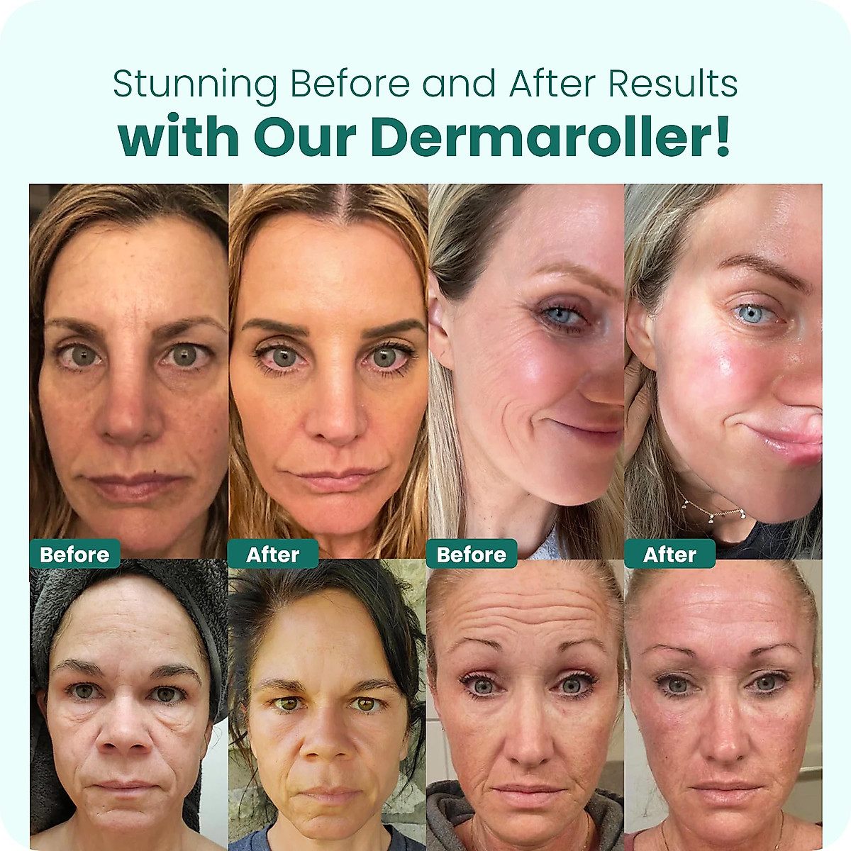 Gin Amber Dermaroller (0.25mm) - 192 Real Individual Needles, Microdermabrasion Device for Skin Care, Serum Absorption with Microneedling, Safe and Painless Revitalizer Tool, Hygienic Case