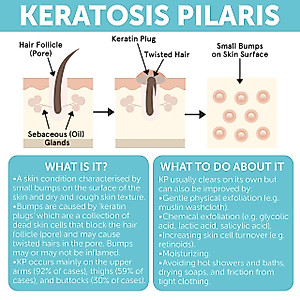 KP Bump Eraser Body Scrub, Keratosis Pilaris Treatment, Strawberry Legs Treatment for Women, Bump Eraser Body Scrub, Keratosis Pilaris, Body Scrub for Strawberry Legs