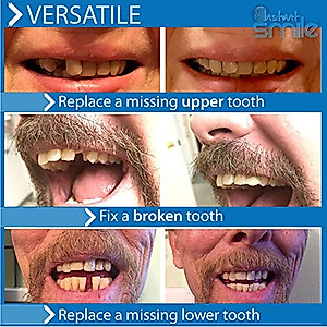 Instant Smile Temporary Tooth Kit -Pro-Series