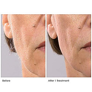 Michael Todd Sonicsmooth Replacement Kit for At-Home Dermaplaning