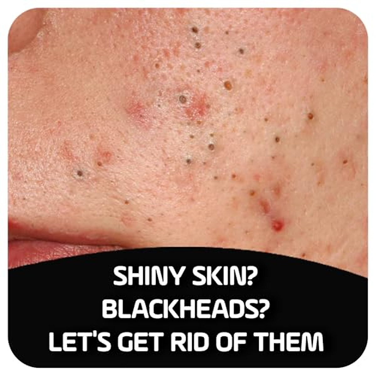 Asepxia with Activated Charcoal Purifying Effect Acne Treatment Bar Soap with Salicylic Acid, 4 Ounce