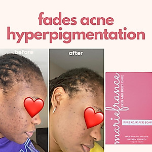 Pure Kojic Acid Soap for Hyperpigmentation, Dark Spots & Skin Brightening with Papaya Extract, Vitamin C & E - Maximum Strength, Fragrance-free, 5.3 oz