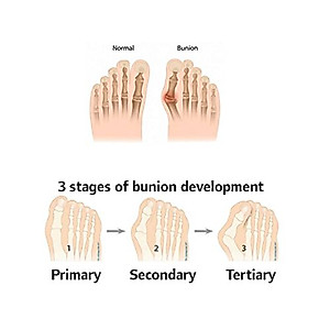 BORT Valco® Hallux Valgus Bunion Night Splint Bunion Corrector Bunion Splint Big Toe Straightener Hammertoe Hallux Valgus Foot Pain Relief Compare to Valguloc Bunion Splint-medium-right