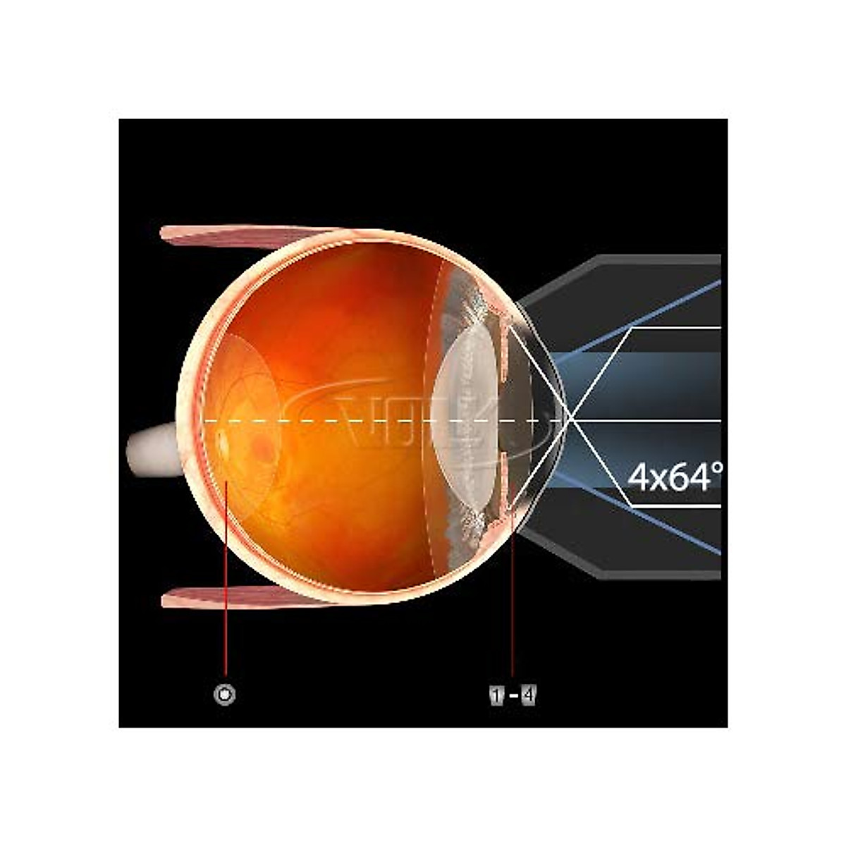 Volk G-4 Gonio Lens - Numerous Contact Type, Handle and Ring Size Options (G-4 High Mag Gonio, No Flange, Small Ring)