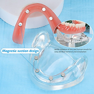 faruijie Overdenture Model - Implant Overdenture Model Lower Denture Model with Four Implants Dental Model Overdenture for Teaching and Studying