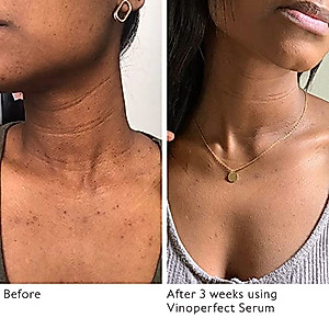 Caudalie Vinoperfect Radiance Dark Spot Serum - 62x more effective than Vitamin C (Gift Set)