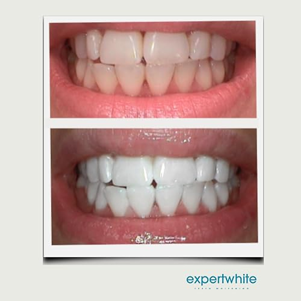 Expertwhite Teeth Whitening Gel Refills (6-gels). Made USA. 44 percent Carbamide Peroxide Tooth Bleaching Gel bleach For Invisalign style trays, Dental Grade Tooth Whitener. 6 syringes