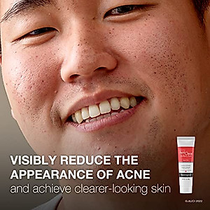 Neutrogena Rapid Clear Stubborn Acne Spot Treatment Gel with Maximum Strength 10% Benzoyl Peroxide Acne Treatment Medication, Pimple Cream for Acne Prone Skin Care, 1 oz