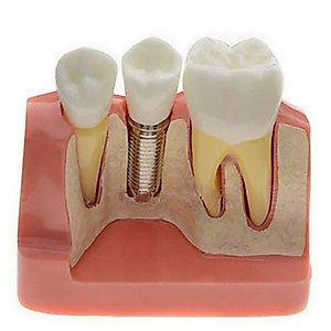 Analysis Model for Dental Implant Crown Bridge Demonstration Teeth Model for Education M2017