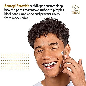 AcneFree Terminator 10 Acne Spot Treatment with Benzoyl Peroxide 10% Maximum Strength Acne Cream Treatment, 1 Ounce - Pack Of 1