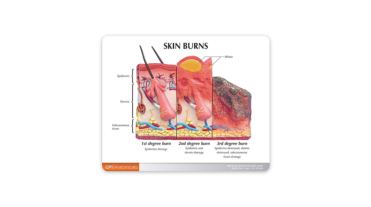 Skin Burn Model for Dermatology Education | GPI Anatomicals